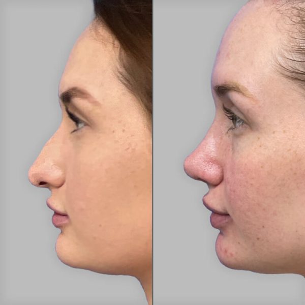 Rhinoplasty & Nose Correction Surgery Sydney | Dr Zacharia