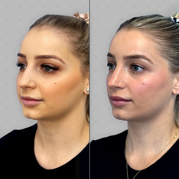 Rhinoplasty & Nose Correction Surgery Sydney | Dr Zacharia